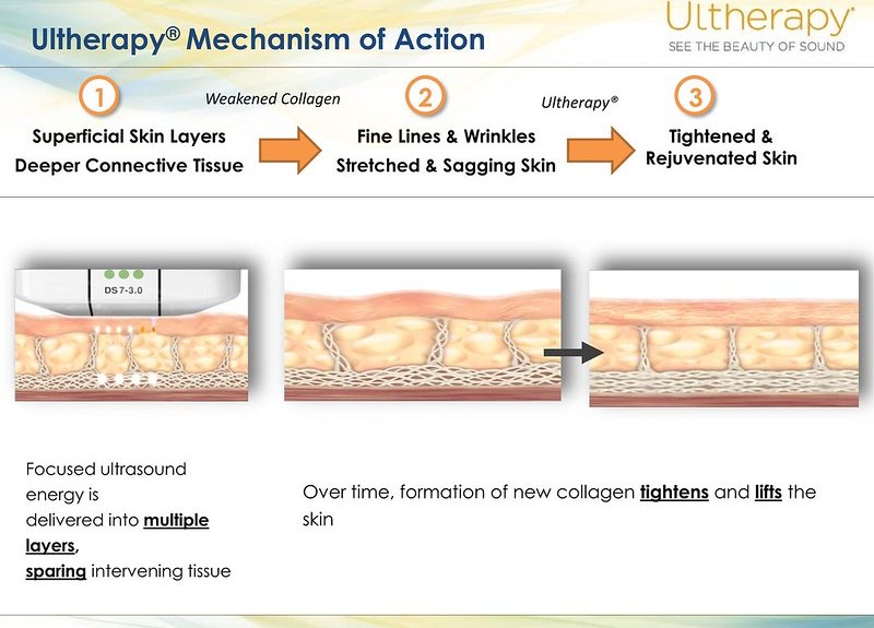 มาเข้าใจและรู้จัก Ulthera 2020 “ฉบับรูปภาพ” แบบคนไม่รู้ ข้อมูลใหม่ ...